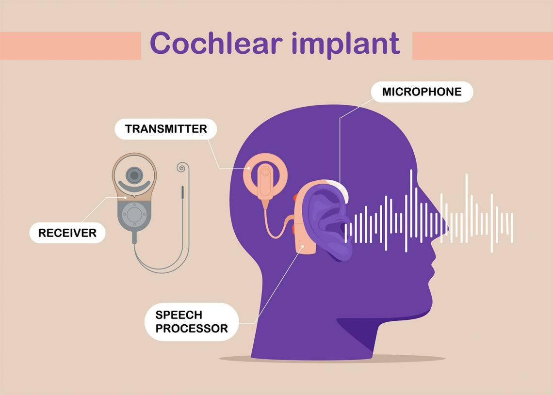 Cochlear Implants | Auditorey